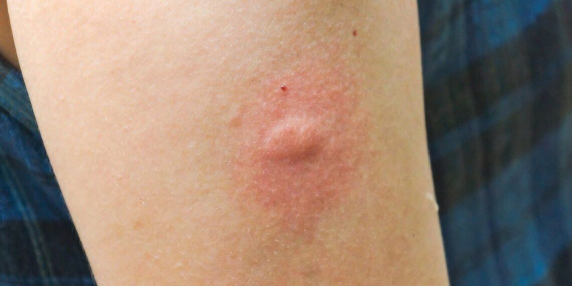 As 6 pomadas mais indicadas para tratar Picadas de Insetos - Correio ...